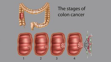 Colon Cancer Diagnosis and Treatment in Thailand - Almurshidi Medical ...