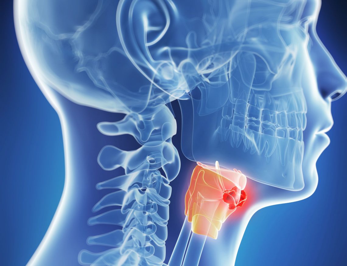 Laryngeal cancer Archives - Almurshidi Medical Tourism - Best ...