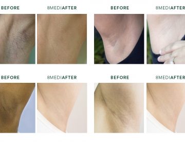 Armpit Whitening Laser Treatment in Thailand Archives - Almurshidi ...