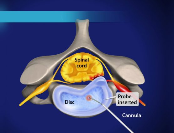 nucleoplasty Archives - Almurshidi Medical Tourism - Best Affordable ...